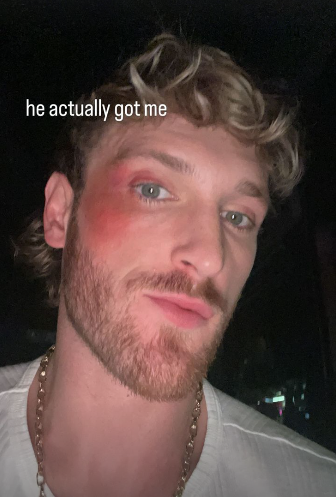 Logan Paul Gets Punched in Face by Rival, Shows off Bruise